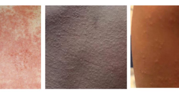 Group A Strep - What you need to know | Healthwatch Wandsworth